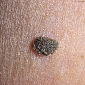 How does common skin lesions look? – Skinive