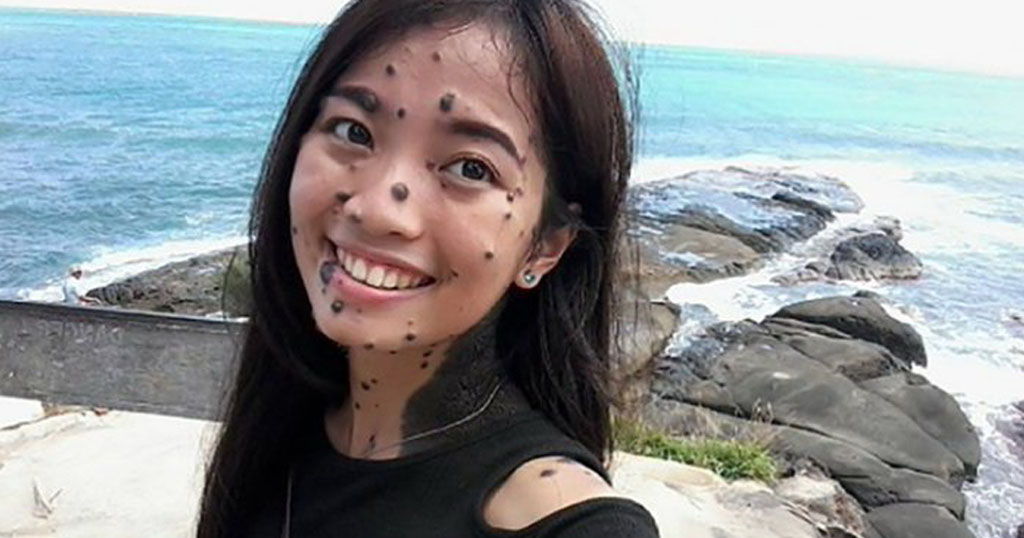 Woman Born With Moles All Over Her Body Is Trying Out for Miss Universe