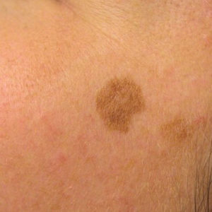 How does common skin lesions look? – Skinive