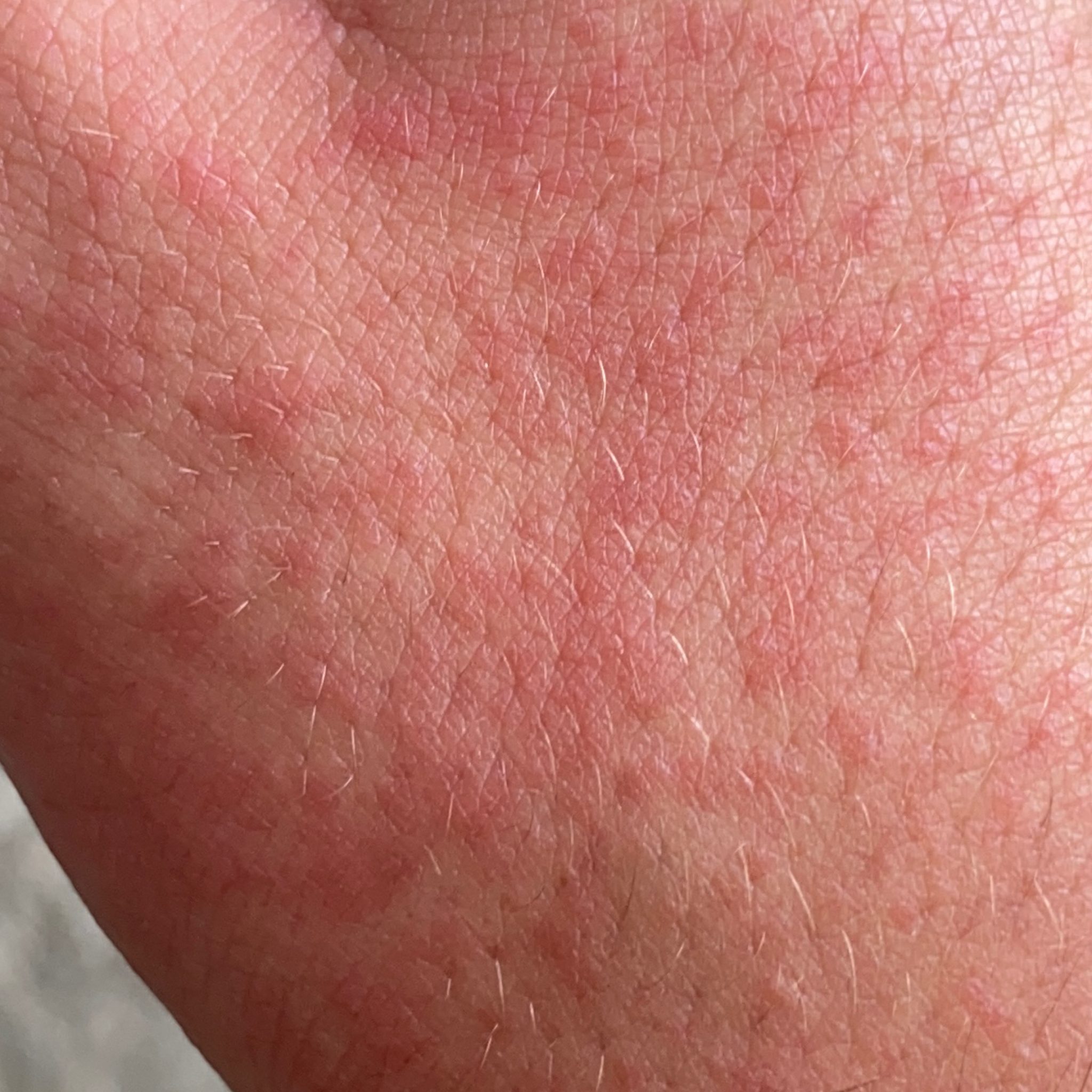Ecz ma Et Dermatite Types Sympt mes Et Traitement Online AI Ecz ma Et Dermatite Types Sympt mes Et Traitement Online AI