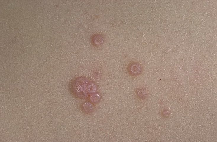 Skin Infections Understanding Viral Afflictions And Their Diagnosis Skin Infections Understanding Viral Afflictions And Their Diagnosis