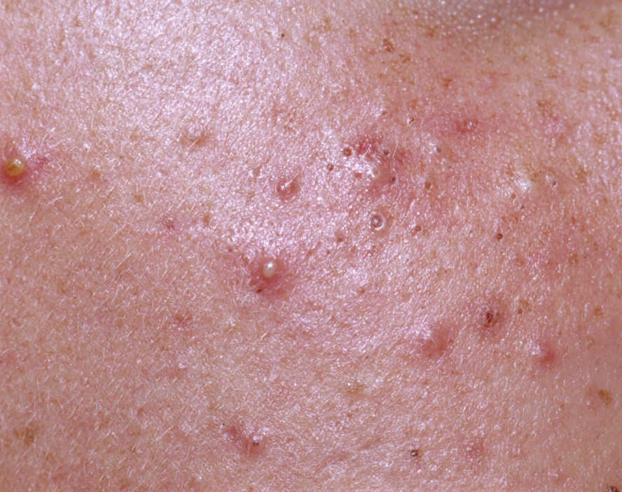 Acne Pustular ICD 10 L70 Online Consultation AI Dermatologist Acne Pustular ICD 10 L70 Online Consultation AI Dermatologist