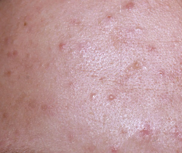 Acne Vulgaris ICD 10 L70 Online Consultation AI Dermatologist Acne Vulgaris ICD 10 L70 Online Consultation AI Dermatologist
