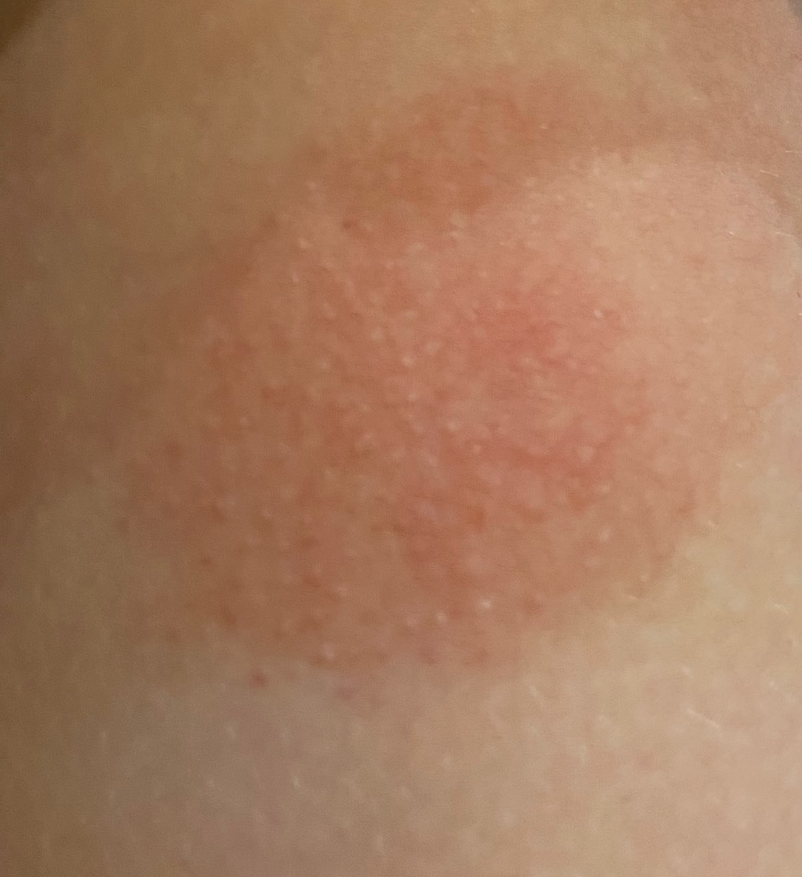 Dermatitis ICD 11 EA8Z ICD 10 L20 Online AI Dermatologist Dermatitis ICD 11 EA8Z ICD 10 L20 Online AI Dermatologist
