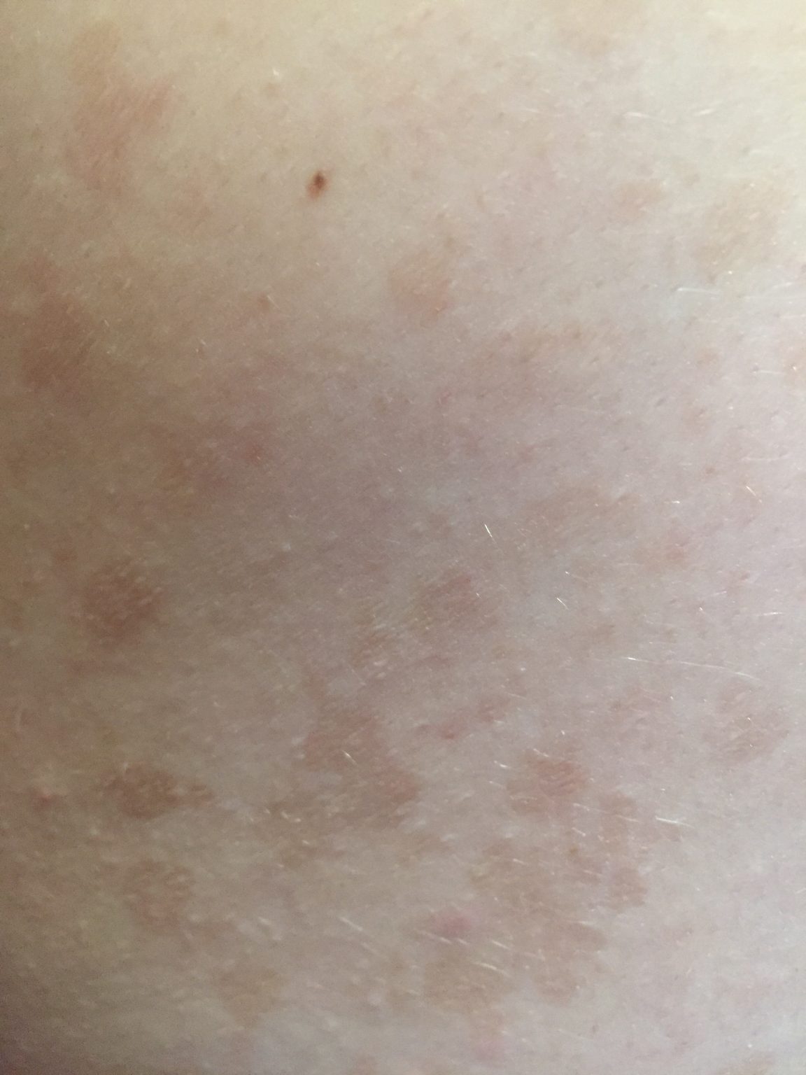 Tinea Versicolor (Pityriasis Versicolor): symptoms, photos, AI analysis ...