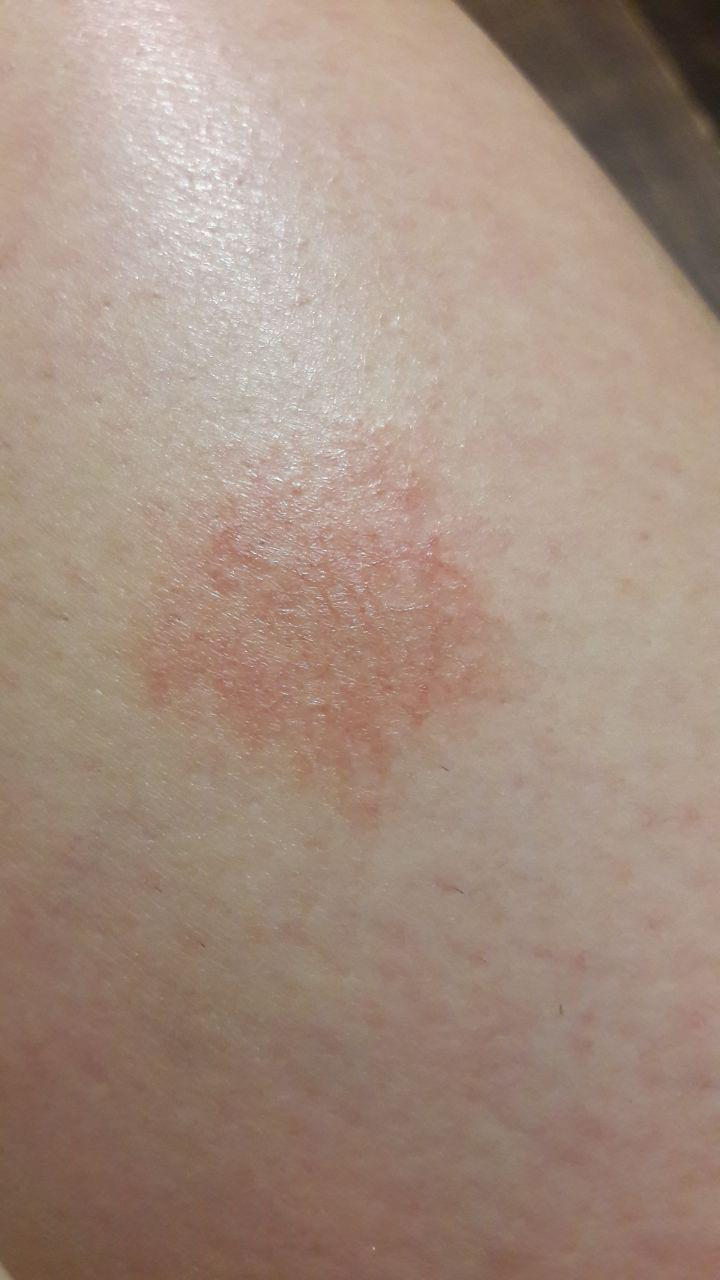 Ecz ma Et Dermatite Types Sympt mes Et Traitement Online AI