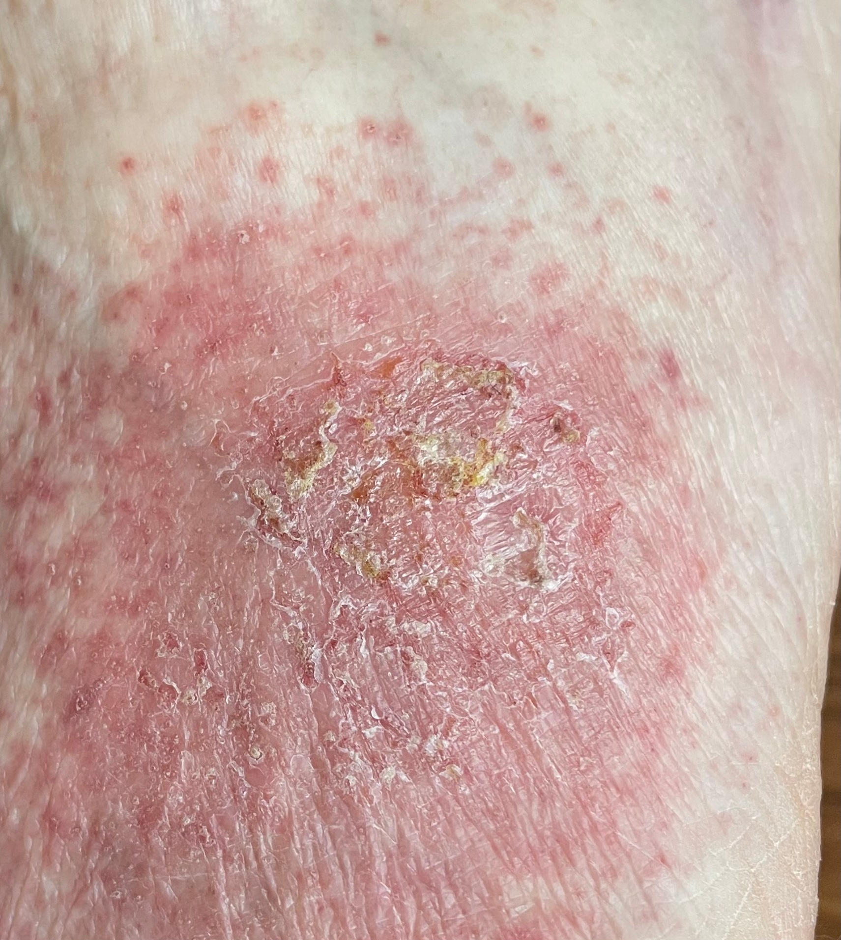 Nodules On Skin Icd 10 Nodules On Skin Icd 10