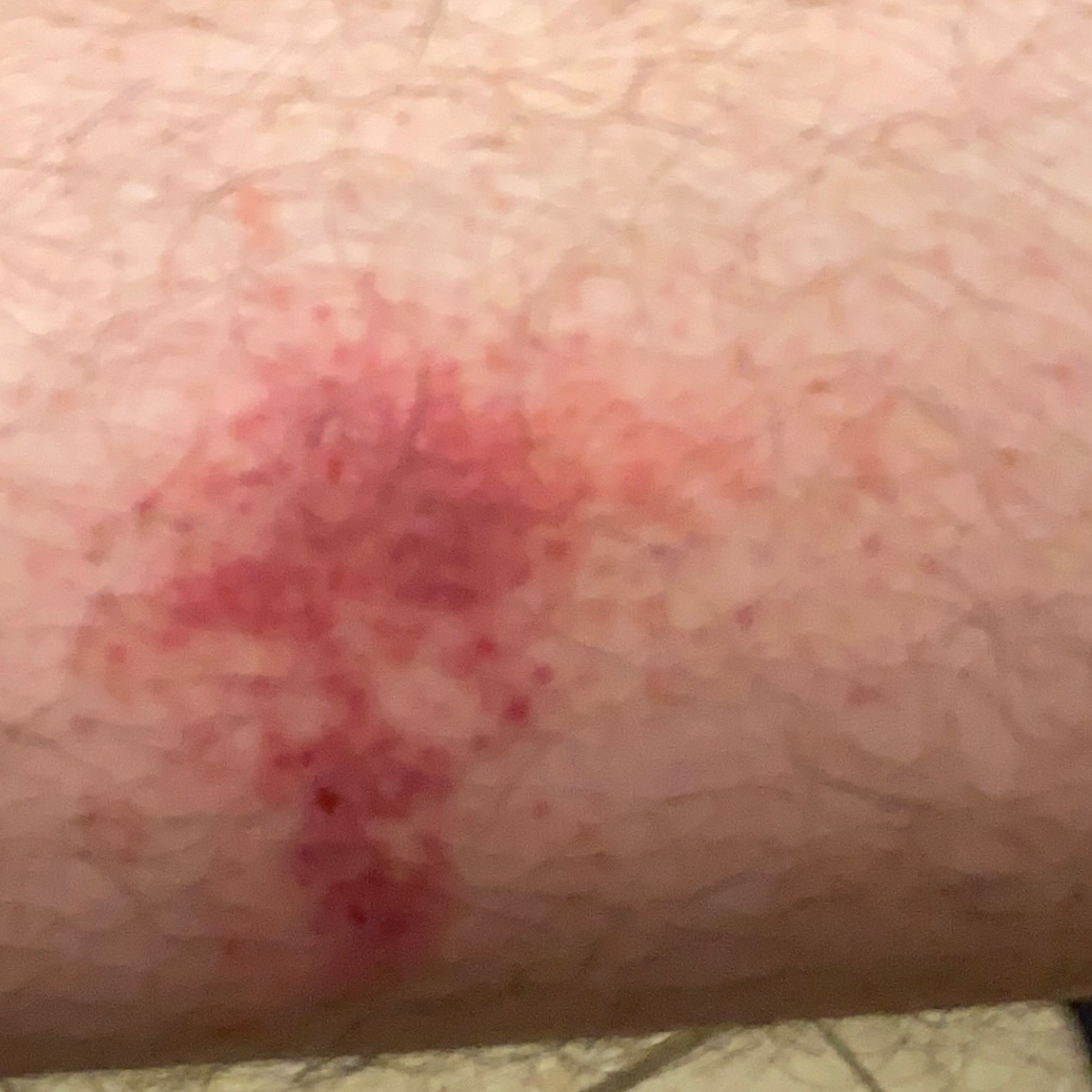 Fungal Diaper Rash Icd 10 At Enrique Branham Blog Fungal Diaper Rash Icd 10 At Enrique Branham Blog