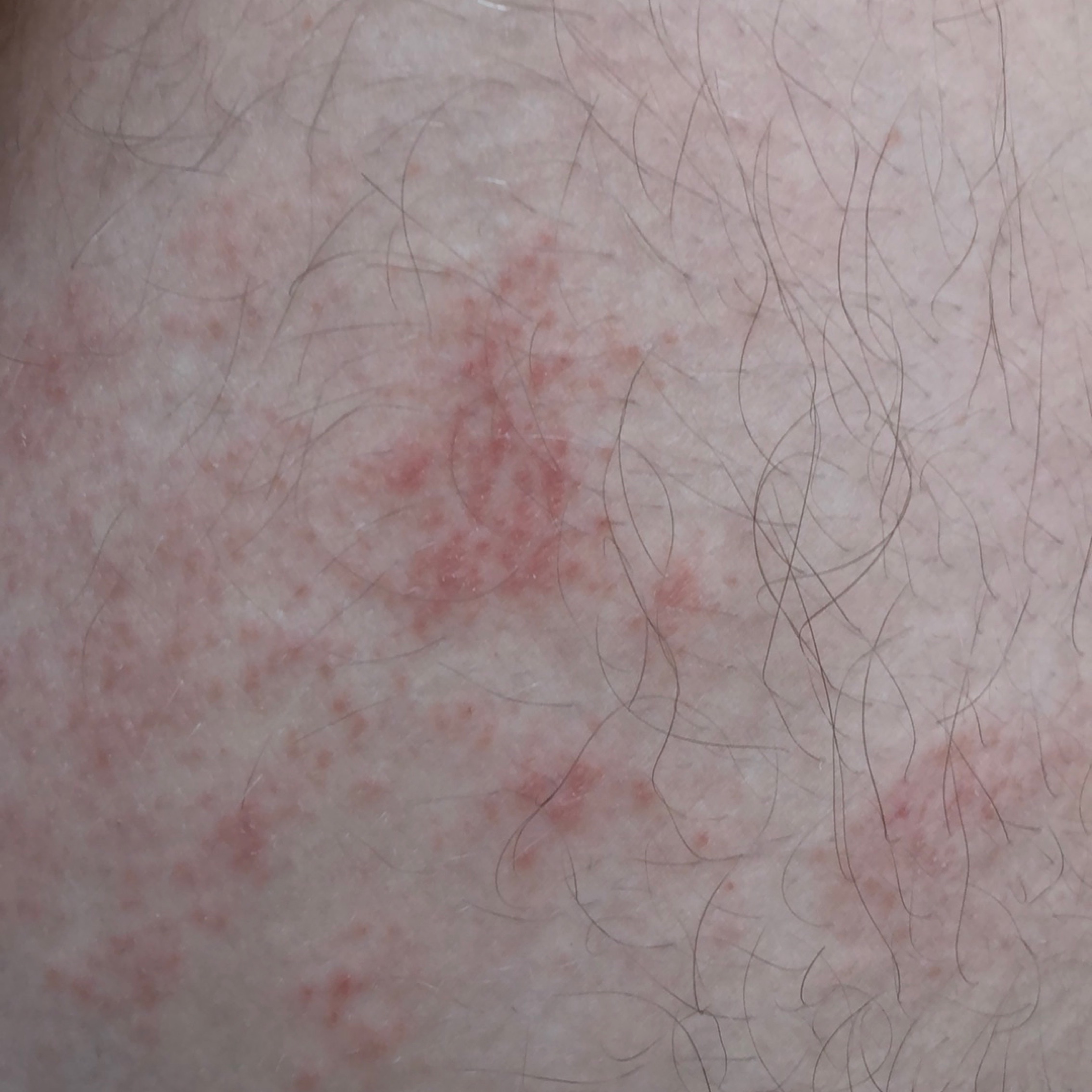 Fungal Diaper Rash Icd 10 At Enrique Branham Blog Fungal Diaper Rash Icd 10 At Enrique Branham Blog