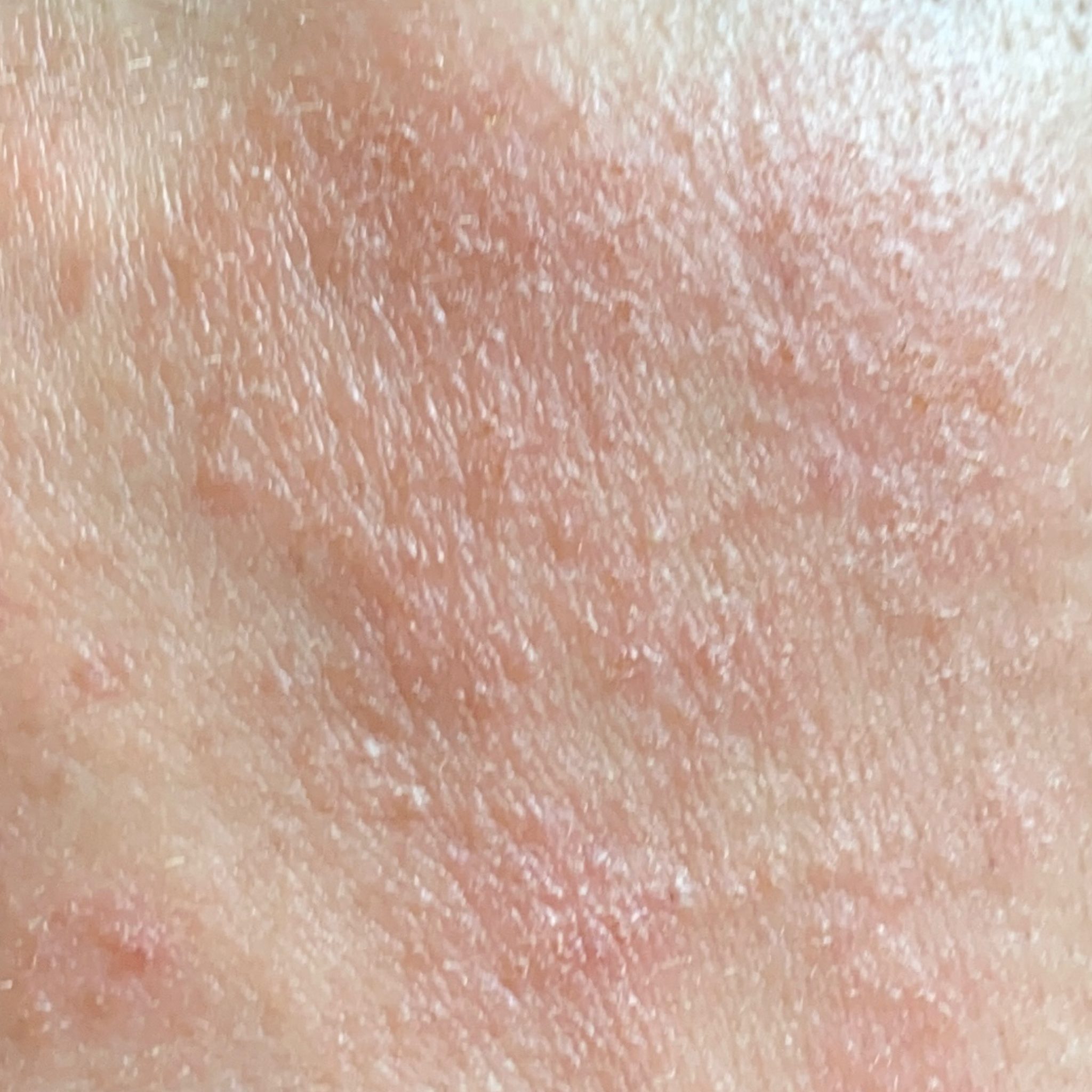 Atopic Dermatitis (ICD-11: EA8Z / ICD-10: L20) 🚨 - Online AI Dermatologist