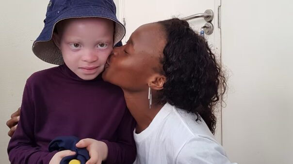 Albinism, Sun, and Skin Health: Why Protection and Early Detection Save ...